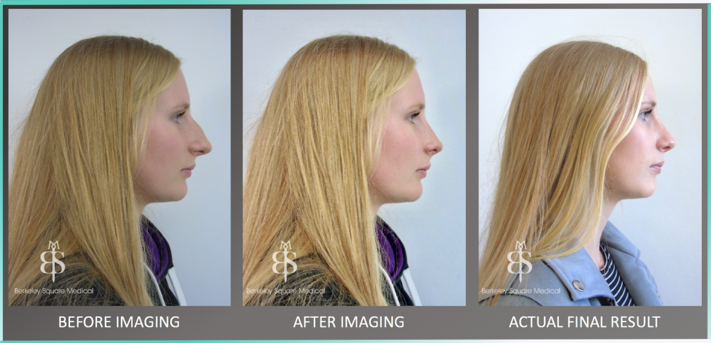 Mens Rhinoplasty (Nose job) | Cosmetic nose surgery | UK