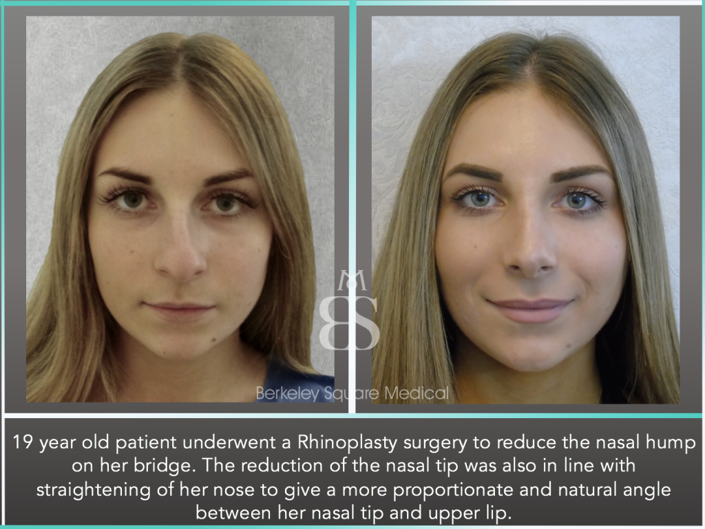 Rhinoplasty Before and After - Berkeley Square Medical - Central London