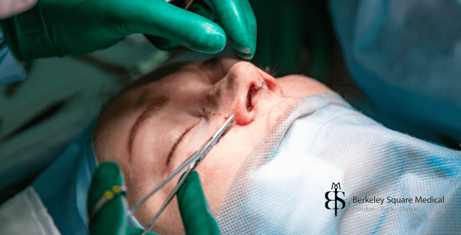 Open Rhinoplasty - A Comprehensive Guide for Patients - Berkeley Square ...
