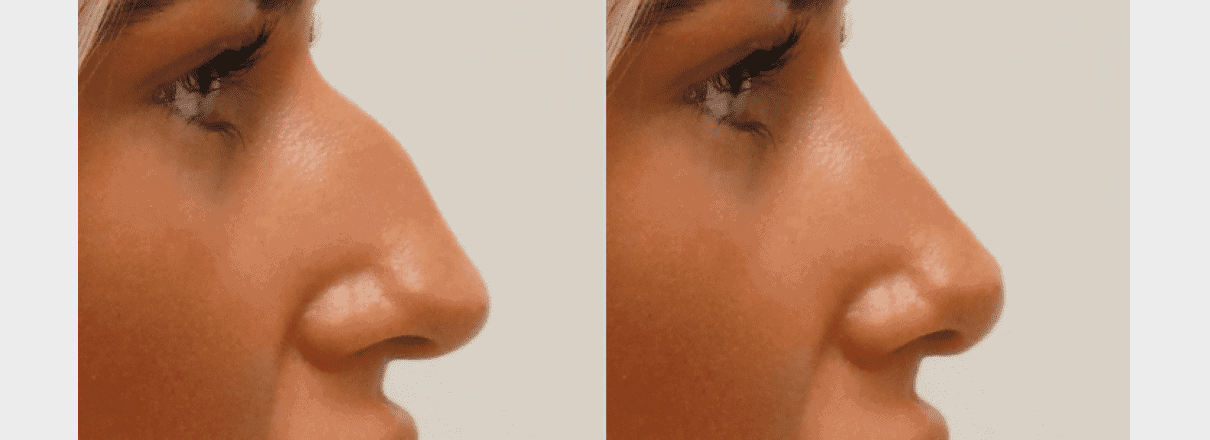 Rhinoplasty (Nose Job) in London, UK | Photos, Cost, FAQs